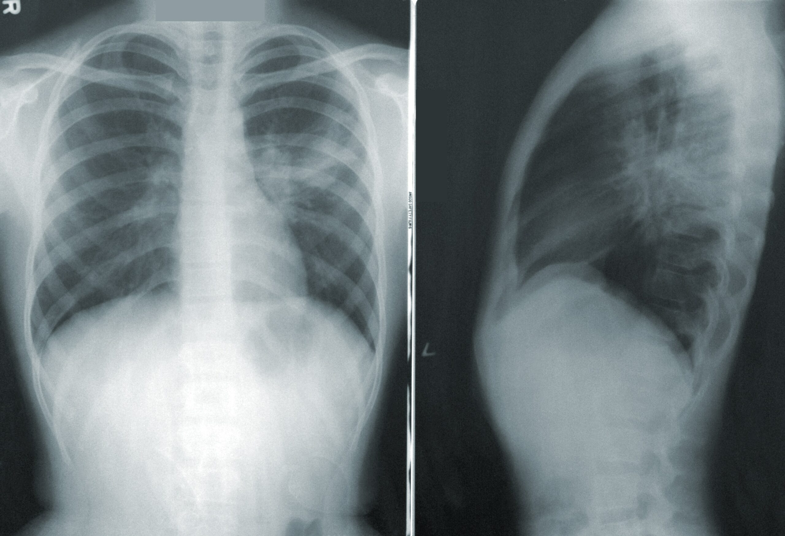 Why OG Tube Placement is Confirmed with X-Rays